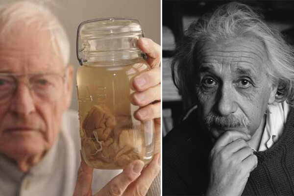 Albert Einstein’s brain after it was stolen from his body